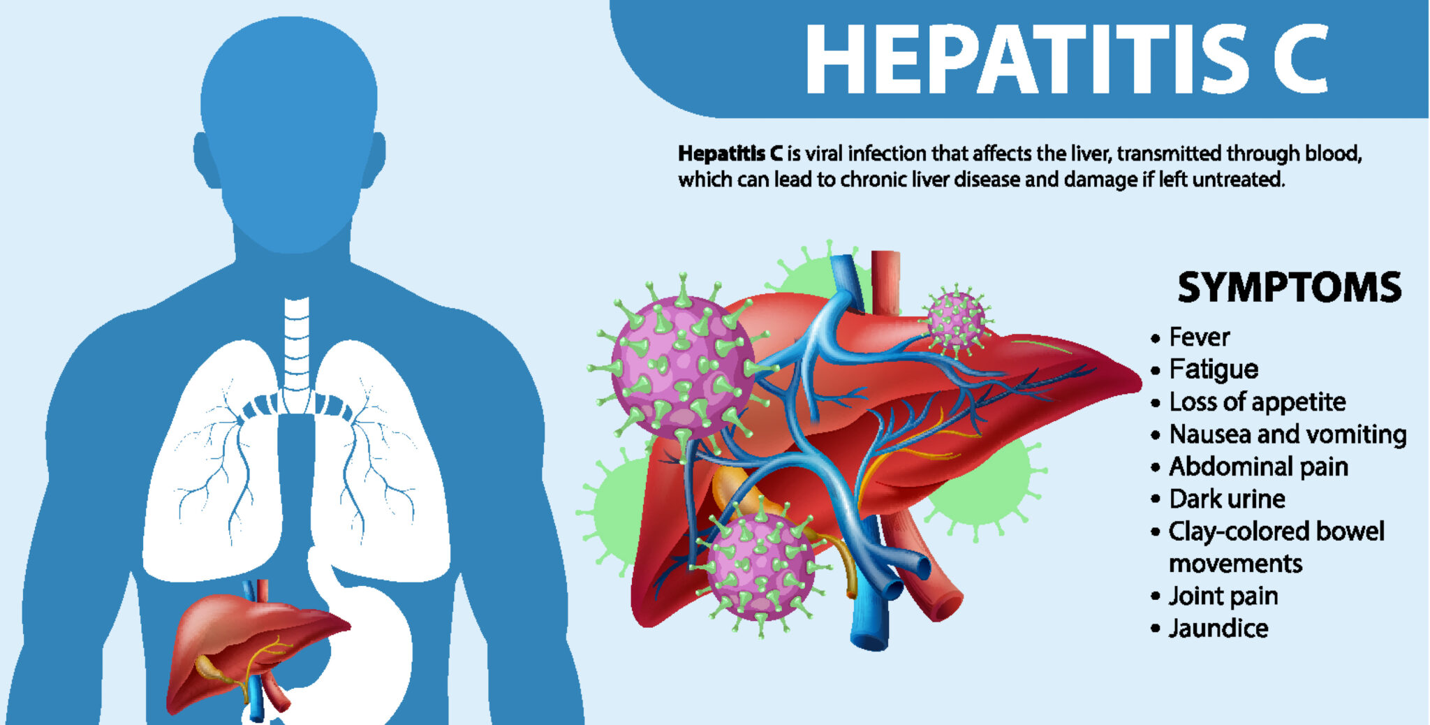 Hepatitis C targeted for global eradication – Kaitiaki Nursing New Zealand